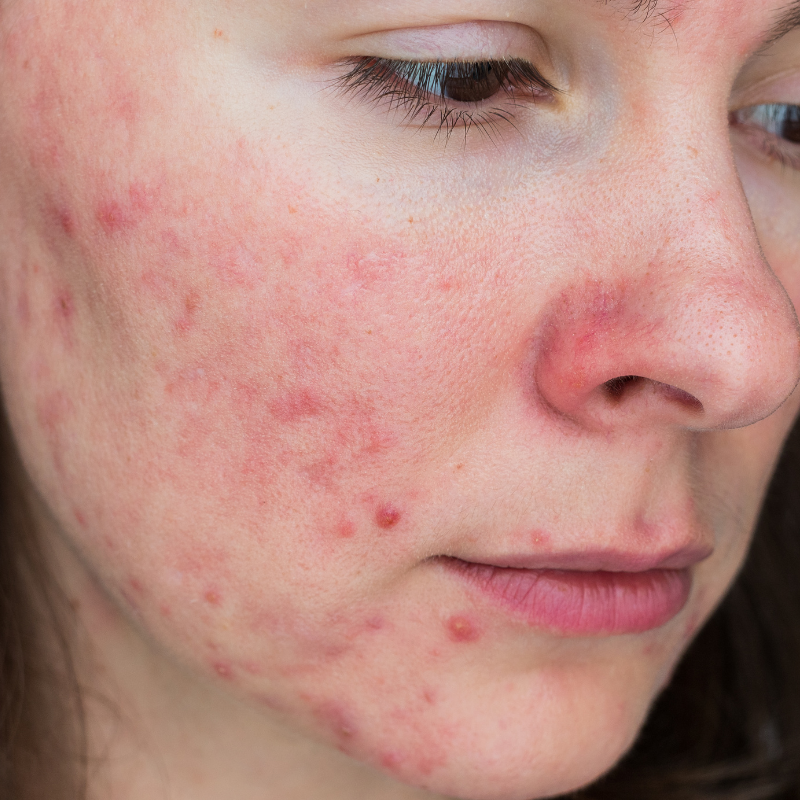 Full Face Rosacea Laser Treatment – Modern Beauty Bar