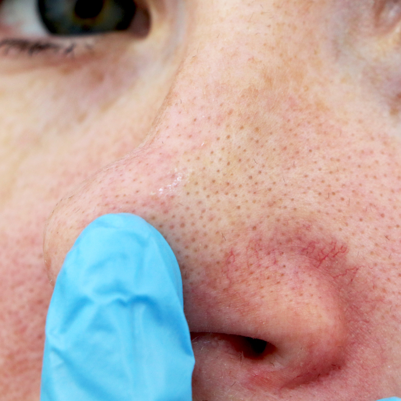 Nose Rosacea Laser Treatment – Modern Beauty Bar